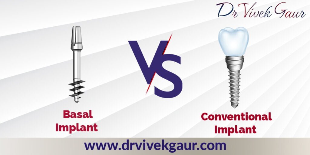 Benefits Of Basal Implants And Its Comparison With Conventional Implants