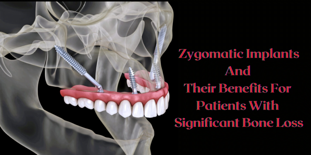 Zygomatic Implants And Their Benefits For Patients with Significant ...
