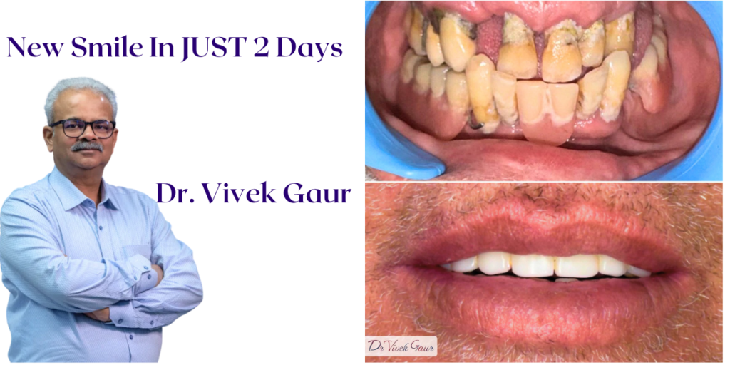 Transform Your Smile In Just 48 Hours: The Dr. Vivek Gaur Experience