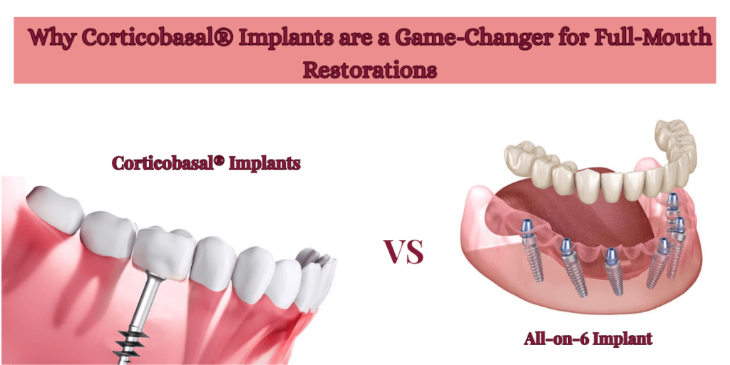 Corticobasal® vs. All-on-4 and All-on 6: Why Corticobasal® Implants are ...