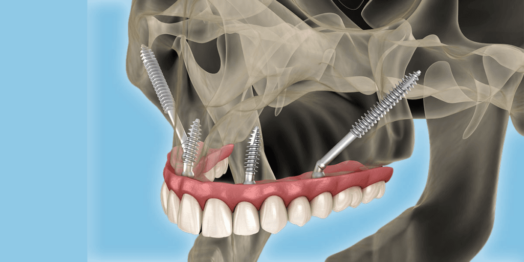 Zygomatic Implants In Corticobasal® Implantology: A Simpler Solution to ...